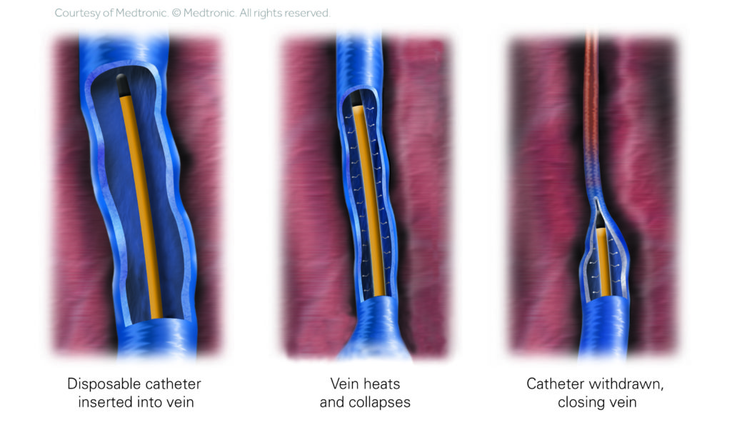 ClosureFast-Procedure-3-Step-Illustration – Oceana Vein Specialists