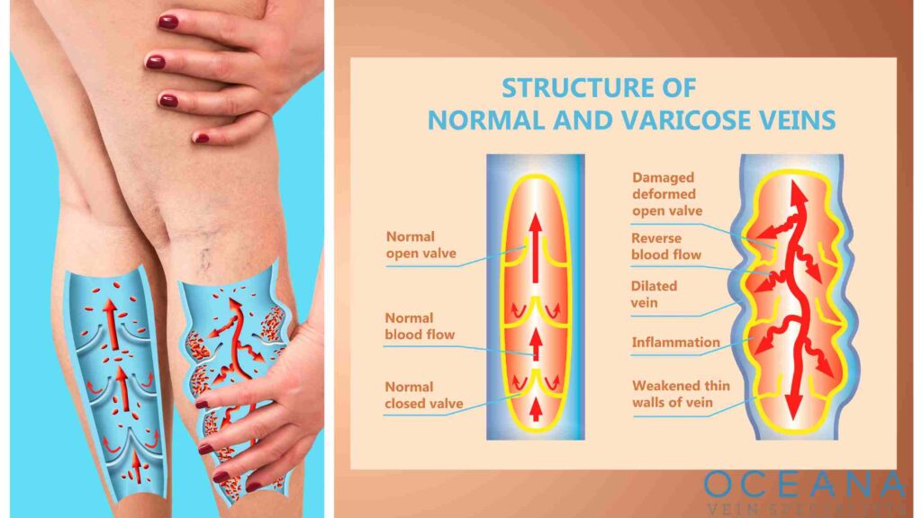 What is a Vein Doctor Called? - Oceana Vein Specialists